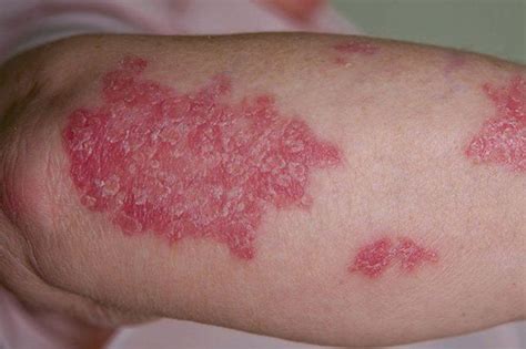 Psoriasis Vulgaris Medizzy
