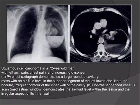 Lung Cancer Radiology Pptx