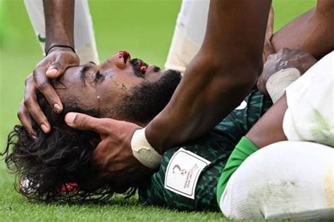 Fractura De Mandíbula Y Cráneo La Terrible Lesión Del Defensor De Arabia Saudita Telefe Noticias