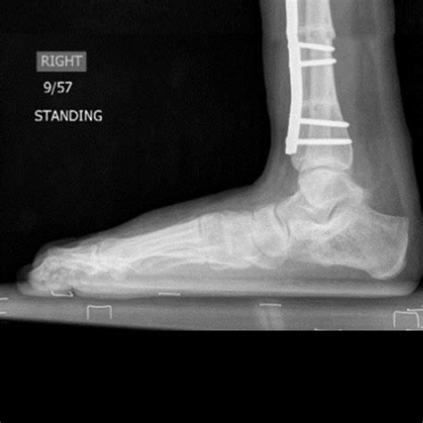 Surgery For Gait Optimization In Cerebral Palsy Dr Assad Qureshi