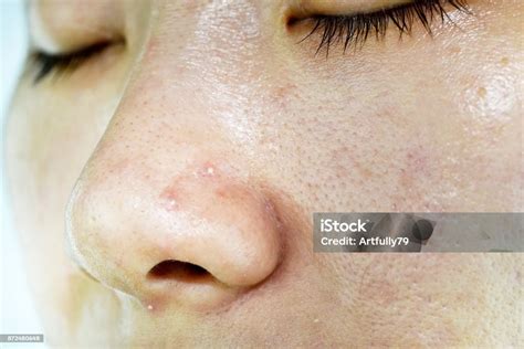 Skin Problem With Acne Diseases Close Up Woman Face With Whitehead Pimples On Nose Scar And Oily ...