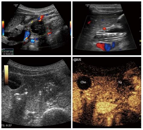 Diagnostic Accuracy Of Transabdominal Ultrasound In Chronic 56 Off