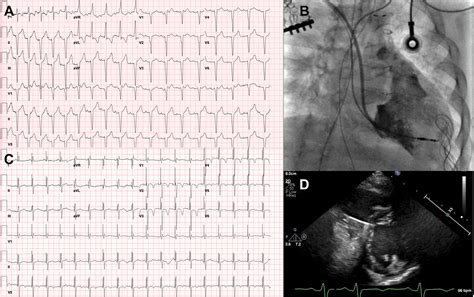 Conduction System Pacing For Patients With Congenital Heart Disease Cardiac Electrophysiology