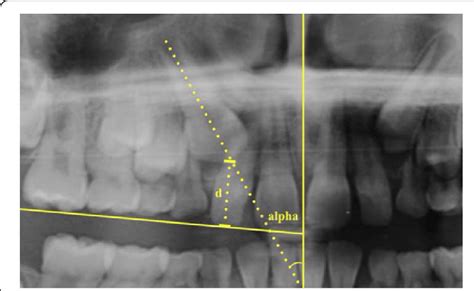 Diagrammatic Representation Of The Measurement Of The Angulation And