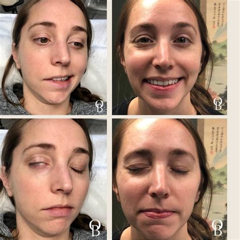 Bells Palsy Archives Old Bridge Acupuncture And Wellness