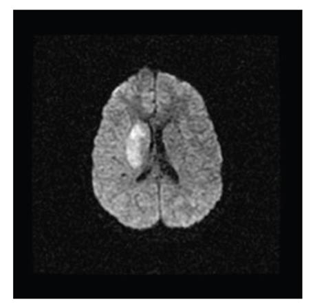 Diffusion Weighted Imaging DWI Showing Area Of Restricted Diffusion