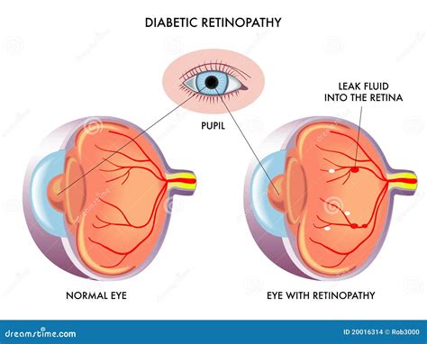 Diabetic Retinopathy Ophthalmoscopic Diagnosis Illustration Royalty Free Cartoon