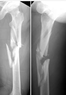 Effective Comminuted Fracture Treatment Expert Tips For A Speedy Recovery
