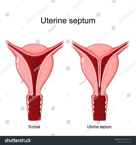 Uterine Septum Comparison Difference Between Normal Stock Vector Royalty Free 2212752537