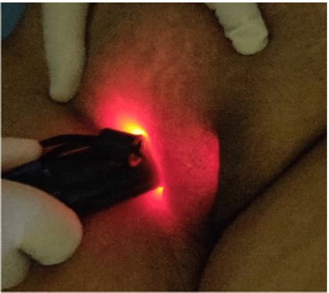 Demonstration Of Positive Transillumination Test Download Scientific