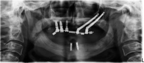 radiographic checking of the bar adaptation opt was done due to the