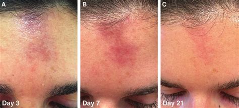 Appearance Of The Patients Forehead At Different Time Points After
