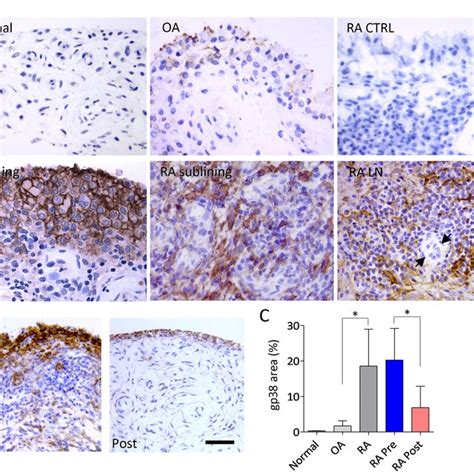 Gp38 Expression Of Cultured Synovial Fibroblasts Sf From Ra Oa And