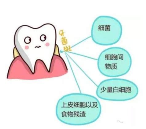 蔗糖八硫酸盐在牙科方面的应用 艾伟拓上海医药科技有限公司