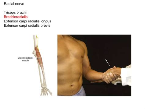 Radial Nerve Entrapment PPTX