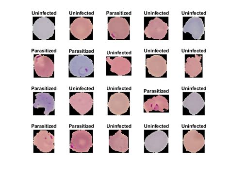 Deep Learning For Medical Imaging Malaria Detection Artificial Intelligence MATLAB Simulink