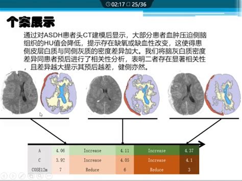 别黎教授基于三维建模定量分析脑灰白质密度差异评估急性硬膜下血肿转归 脑医汇