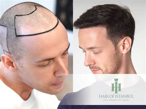 What Does A Dislodged Hair Graft Look Like