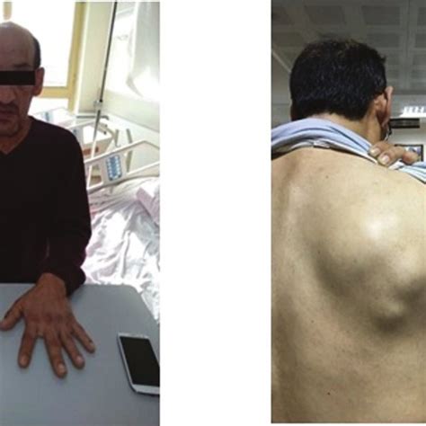 A Physical Examination Of The Patient Had Typicial Acromegalic