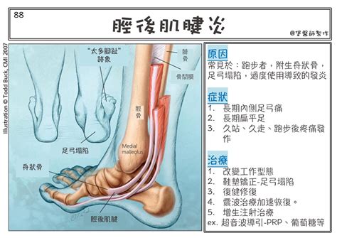 腳底痛怎麼辦？就是足底筋膜炎嗎？原因與治療 台北原力復健科診所 侯鐘堡醫師