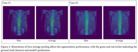 Scientific Research Publishing On Linkedin Bone Metastases Lesion