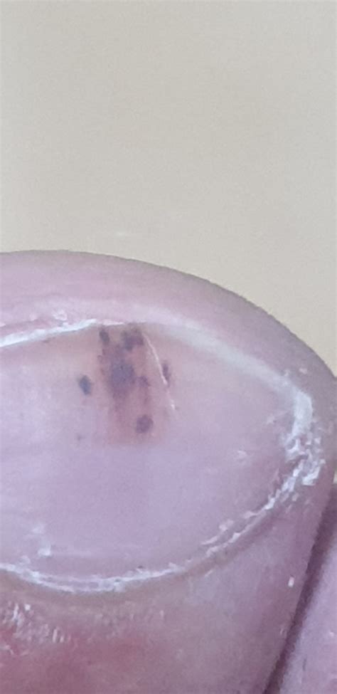 발톱에 있는 검은점 혹시 흑색종인가요 사진 O 지식in