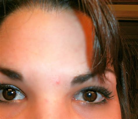 Pin Buster Treating A Pimple With Toothpaste Busted