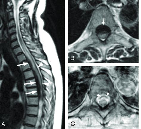 A Sagittal Fast Spin Echo Fse T2 Weighted Image Of The Cervical And