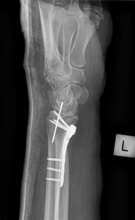Intercondylar Fossa X Ray