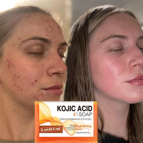 Kojic Acid Soap Before And After Does It Really Lighten Skin Must