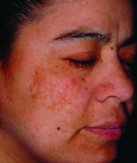 Dyschromia Skinpen Precision By Crown Aesthetics