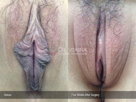 Photo Of Labia Minora Clitoral Hood Reduction Dr Vitasna
