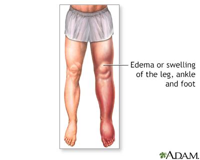 Foot Leg And Ankle Swelling UF Health