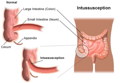 Intussusception Gut And Gastroenterology
