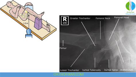 Hip Joint X Ray Imaging