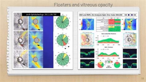 Interpretation Of Oct Glaucoma Pptx