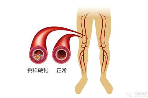 糖尿病慢性并发症 糖尿病下肢血管病变