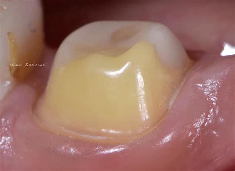 Posterior Crown Preparation Dental Esthetics