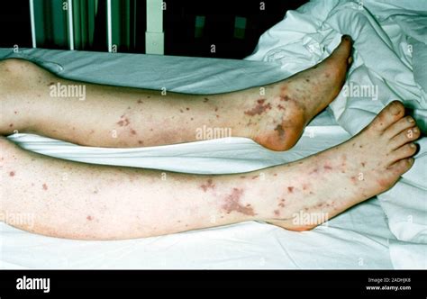 Legs Of A Patient Showing Meningiococcal Septiceamia A Rash Associated