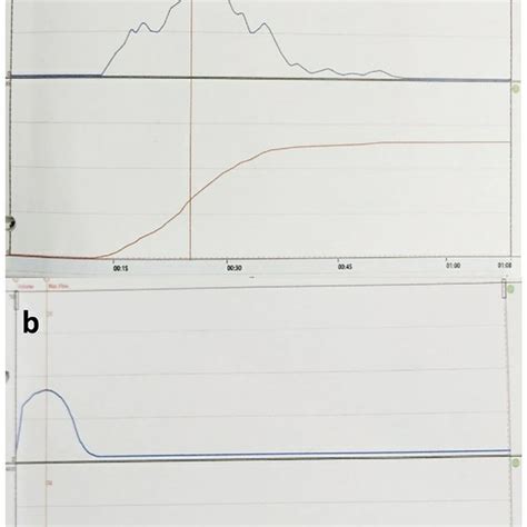 Improvement In The Curve Pattern From A Tower Shaped Uroflow A To Download Scientific Diagram