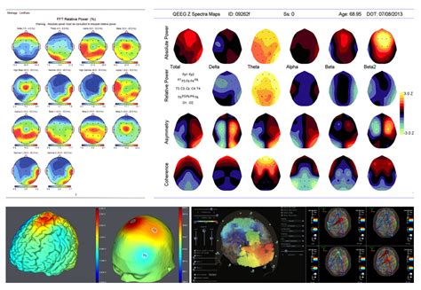 Qeeg Or Quantitative Eeg Brain Maps Is The First Step In Helping You Improve The Quality Of Your