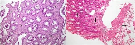 An Ulcerated Friable Mass Was Found On Endoscopy In The Upper Rectum
