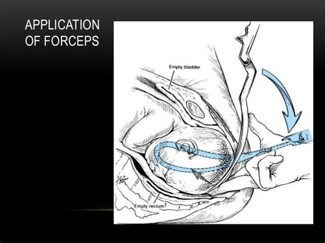 Clinical Pelvimetry And Forceps Assisted Vaginal Delivery