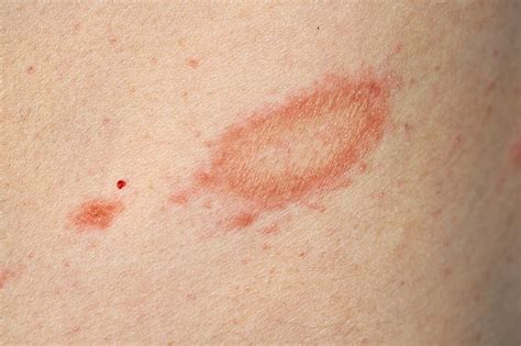 Is Pityriasis Rosea Contagious How Is It Treated