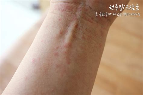 옻이 올랐을때 옻 알레르기치료법 옻독 치료법 데타손연고025 소개참옻진액옻나무옻껍질 네이버 블로그