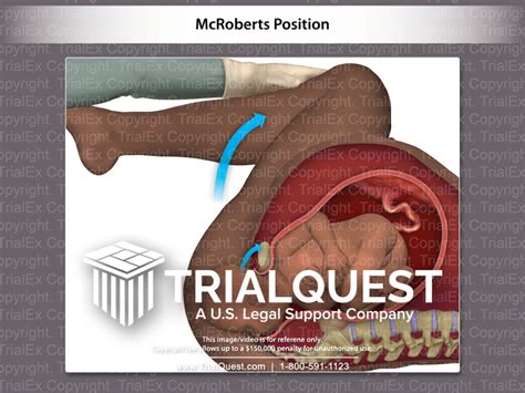 Mcroberts Position Birth