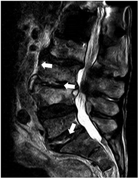 T2 Weighted Sagittal Magnetic Resonance Imaging Mri Scan Of The