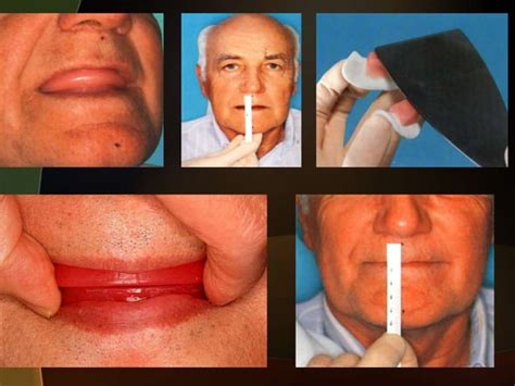 Complete Denture 4 Maxillo Mandibular Relation Records D Vertical