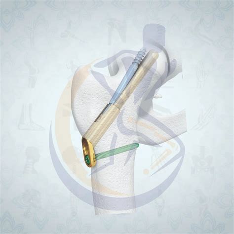 Femoral Neck System At Best Price In Vadodara Id 2854140307212