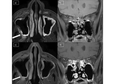A Mri Axial T2w Fs B Coronal Pre Contrast T1w Fs C And D Axial And